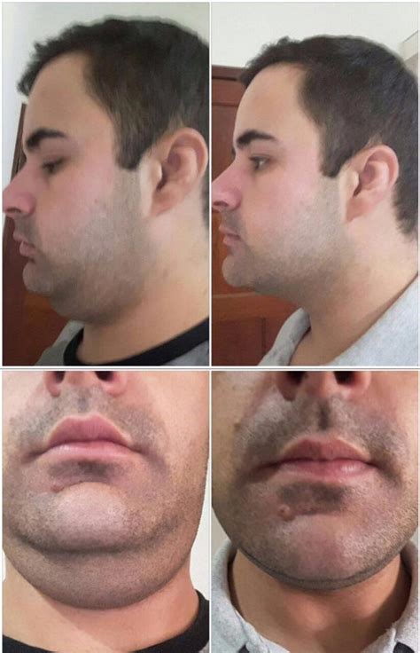 Papada Antes E Depois De Emagrecer Livros