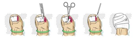 Ingrown Toenail Surgery Sydney An T M