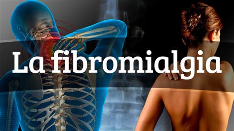 La fibromialgia Causas síntomas y tratamiento YouTube