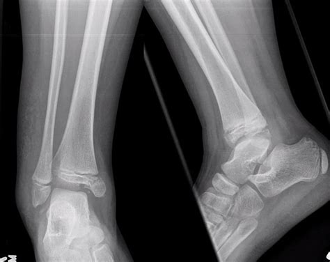 Ankle Fractures Pediatric Pediatrics Orthobullets
