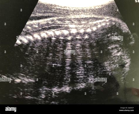 La Ecograf A Fetal Que Muestra La Columna Vertebral Y Las Costillas