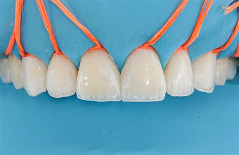 Restauração estética e funcional facetas em resina composta