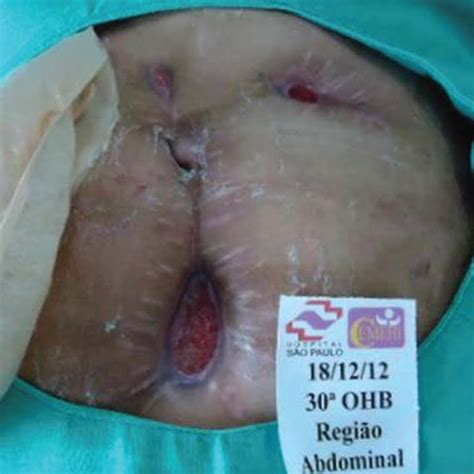 Enterocutaneous Fistula With Active Draining At The Beginning Of