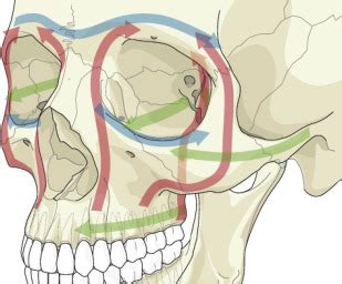 Maxillofacial And Mandibular Fractures In Sports Clinics In Sports