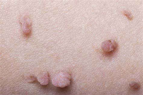 Causas De Las Manchas Rojas Rosadas O Marrones En La Piel Seg N