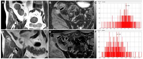 JCM Free Full Text Which Parameter Influences Local Disease Free