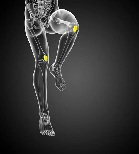 Que es la tendinitis rotuliana Síntomas tratamiento y prevención