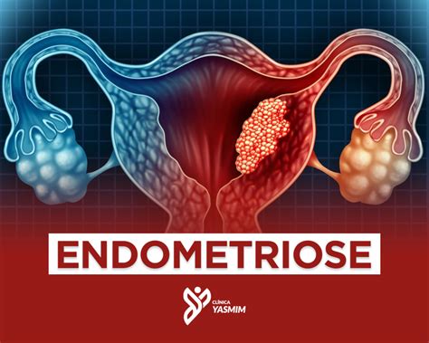 Endometriose Clínica Yasmim Anápolis