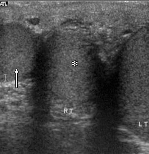 Spectrum Of Extratesticular And Testicular Pathologic Conditions At