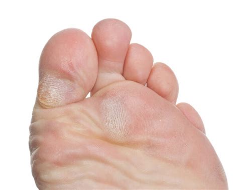 Callos en los pies o callosidades Cómo tratarlos y cómo prevenirlos