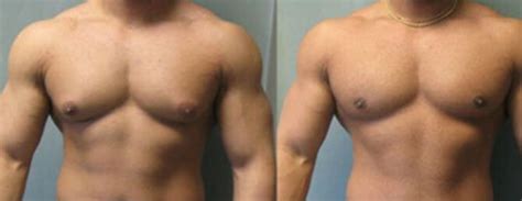 Cirurgia De Ginecomastia Pelo Sus Mastectomia