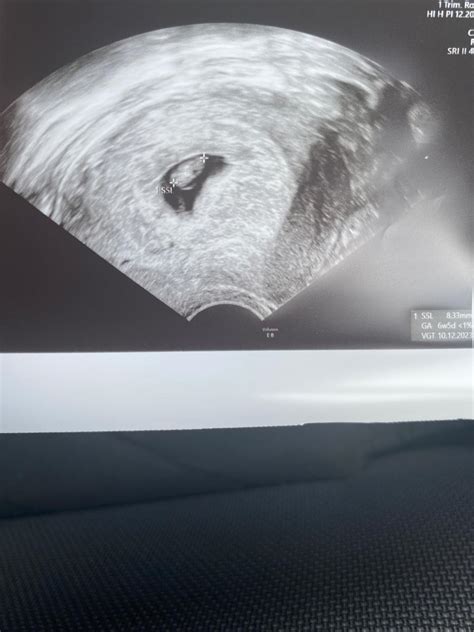 6 5 Ssw Ultraschallbild Was Ist Zu Sehen Forum Schwangerschaft