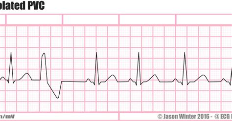 ECG Educator Blog Premature Ventricular Contraction PVC