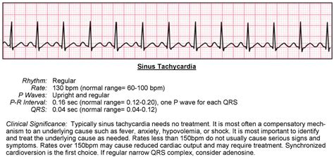Tachycardia ECG ACLS Wiki