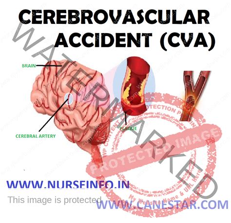 CEREBROVASCULAR ACCIDENT STROKE Nurse Info