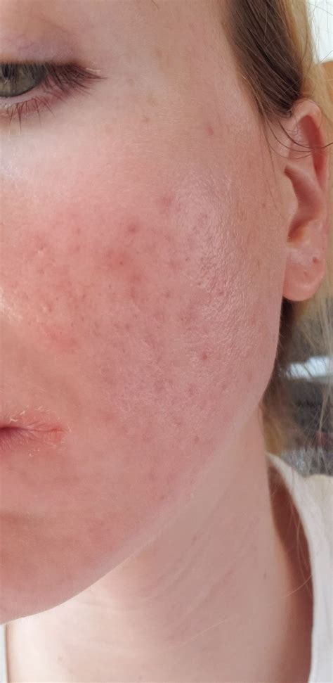 9 Month Accutane Transformation Before After Photos Crystal Clear
