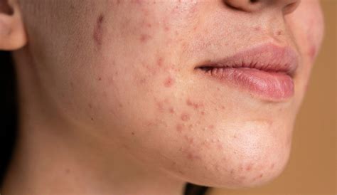 Chemical Peels For Acne Scars A Comprehensive Guide