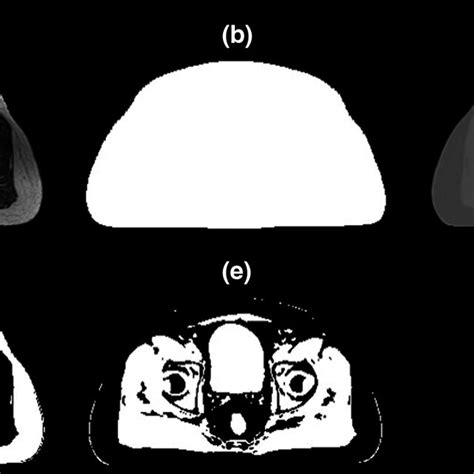 Classification Maps Generated For A Coregistered MRICT Atlas A