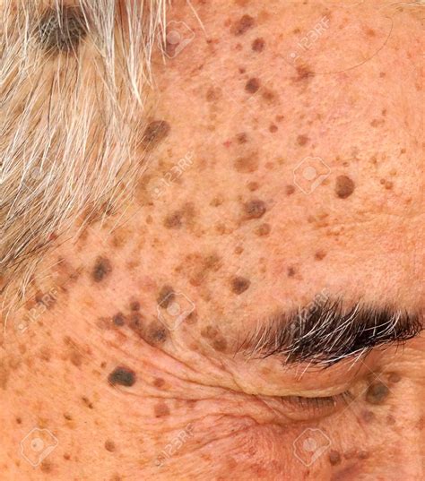 Seborrheic Keratosis Effective Natural Treatment With Homeopathy Artofit