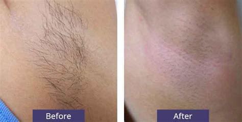 25 Armpit Laser Hair Removal CloverNorman