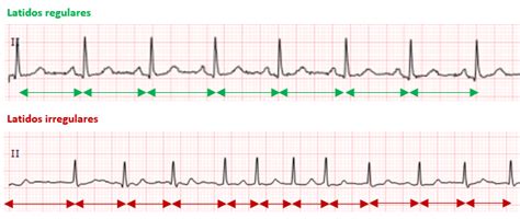 Cómo interpretar un electrocardiograma ECG Fácil