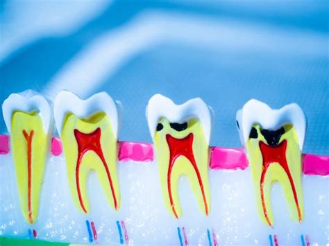 Pulpitis Variantes Y Tratamientos Clinica Dental Seis