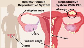 Pelvic Inflammatory Disease PID Doral Health And Wellness Womens