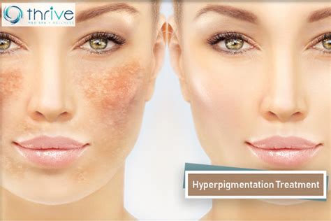 Hyperpigmentation Treatment In Portsmouth NH Thrive Med Spa