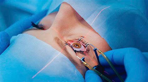 Cirurgia De Catarata Como Funciona Dr Leonardo Garcia