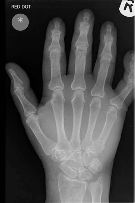 Broken Finger X Ray