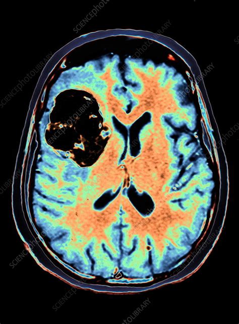 Brain Cancer MRI Stock Image M134 0402 Science Photo Library