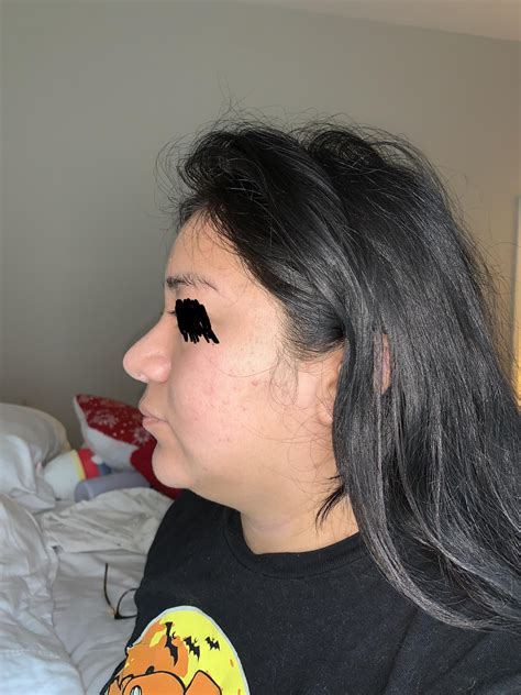 Im 2 Years Post Op Rhinoplasty And Feel Like The Tip Never Went All The Way Down It Still
