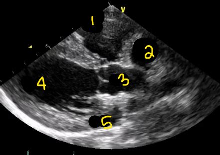 Echocardiography Flashcards Quizlet