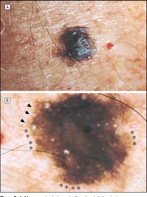 Seborrheic Keratosis Dermoscopy