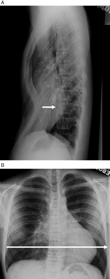 Chest X Ray As A Primary Modality For Preoperative Imaging Of Pectus
