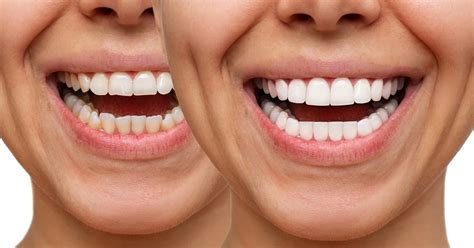 Carillas dentales antes y después pacientes de Clínicas Den