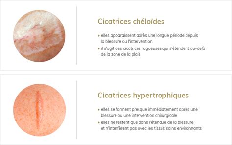 Comment Soigner Et Aplatir Les Cicatrices De Chez Soit En Usilisant Le