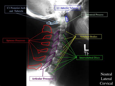 Ppt Normal Radiographic Spinal Anatomy Powerpoint Presentation Free