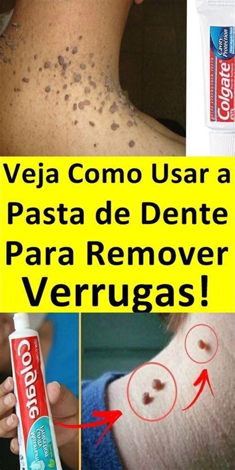 Remedios Naturales Para Eliminar Las Verrugas De Tu Cuerpo Artofit