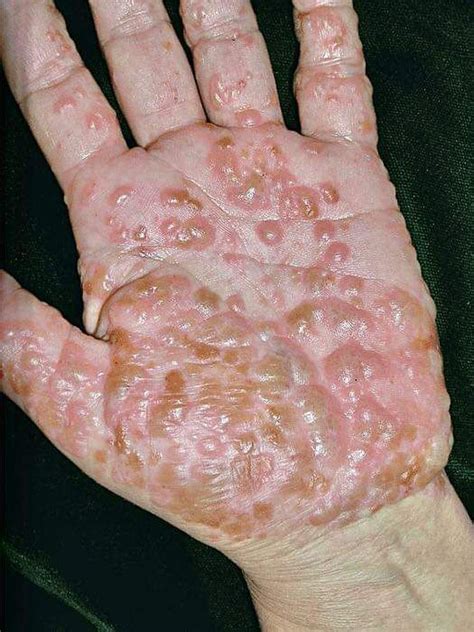 Dyshidrotic Eczema Medizzy