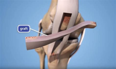 Knee Arthroscopy OrthoInfo AAOS