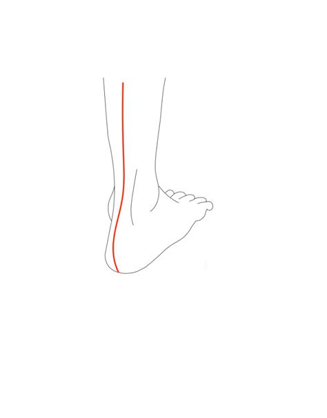 Rupture Ancienne Du Tendon D Achille Dr Bovier Lapierre