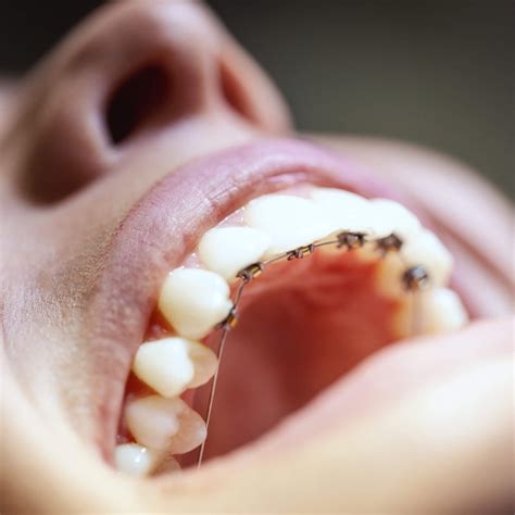 Best Orthodontist In Dubai Business Bay Best Orthodontic Treatment In