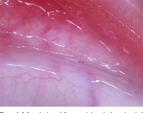 Figure From Diagnosis Of Ophthalmomyiasis Externa By Dermatoscopy