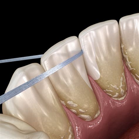 Qu Es La Placa Dental O Placa Bacteriana Hernandez Dental