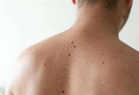 Différence entre carcinome et mélanome Centre chirurgie