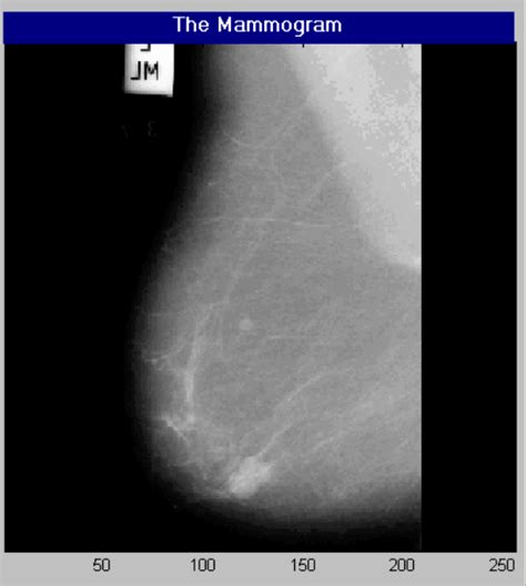 segmentation and detection of micro calcification regions in mammogram using genetic algorithm