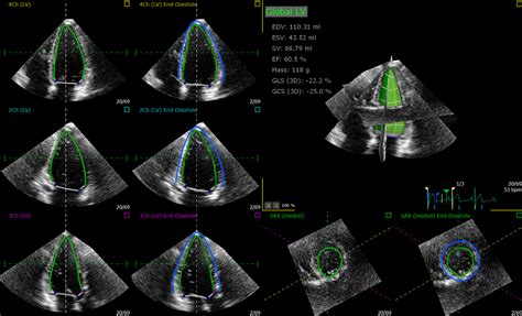 Normal Values Of Left Ventricular Mass By Two Dimensional And Three