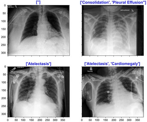 multi label chest x ray classification via deep learning