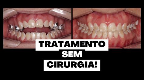 Tratamento Ortodôntico da Mordida Aberta Esquelética Sem Cirurgia